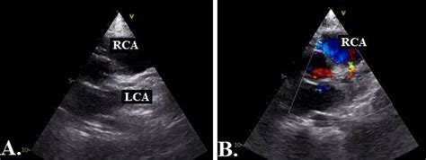 A Transthoracic Echocardiography In Parasternal Short Axis View Download Scientific Diagram