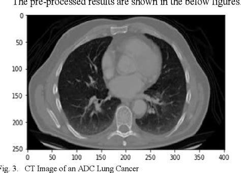 Figure 3 From Classification Of Non Small Cell Lung Cancer Using Deep Learning Semantic Scholar