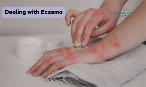 Dealing With Eczema