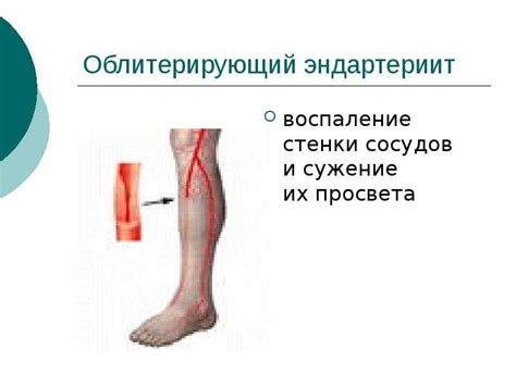 Облитерирующий эндартериит