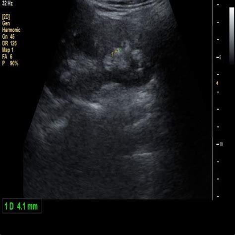 肾结石分类和对象检测数据集 肾结石检测超声图像数据集 含 9416 张原始处理图像 适用于肾结石检测模型训练 医学影像资源 Csdn博客