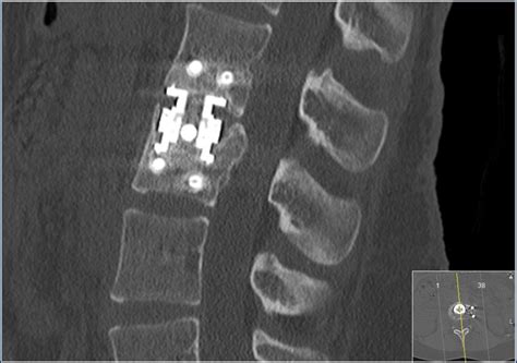 The Radiology Assistant Spine Fractures Tlics Classification