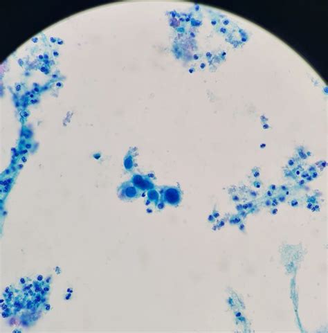 Sara Salih On Linkedin Interesting Finding In Unsatisfactory Pap Smear Hsv