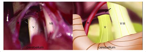 Intraoperative Findings Of Retrosigmoid Craniotomy Left And Download Scientific Diagram
