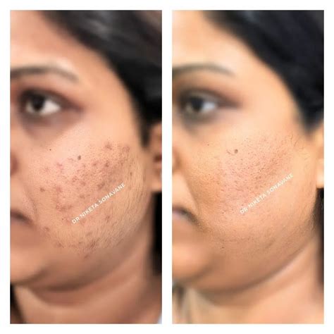 Laser Treatment For Dark Spots