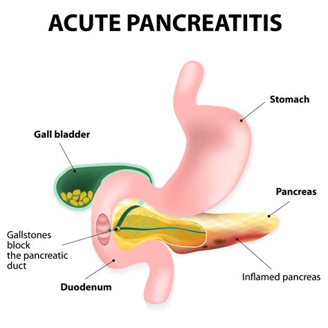 Pancreatitis