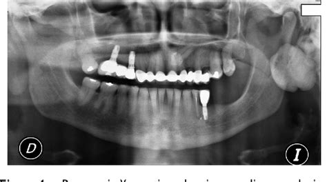 Figure 1 From Giant Peripheral Osteoma Of The Mandible Simulating A Parotid Gland Tumor