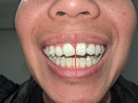 Misaligned Jaw And Invisalign R Invisalign
