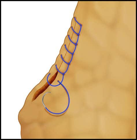 Technique Of Continuous Locking Suture Download Scientific Diagram
