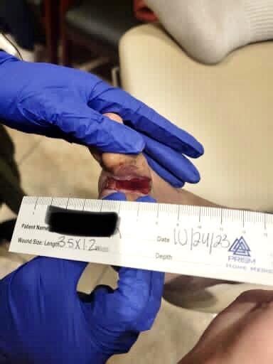 Cellulitis Of The Foot And Toe Rmedicalgore