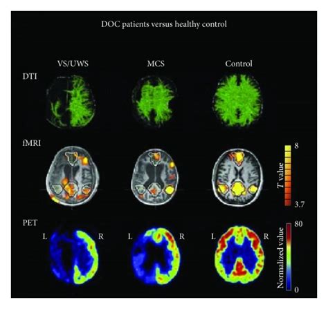 Diffusion Tensor Imaging Default Mode Network As Extracted From Download Scientific Diagram
