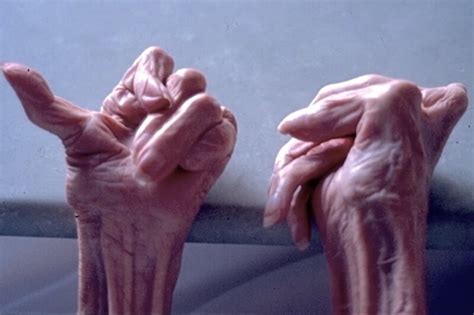 Rhizarthrose Une Arthrose à La Base Du Pouce Pr Eric Roulot