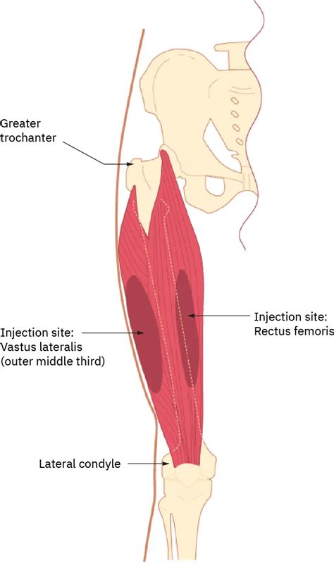 126 Administering Intramuscular Injections Clinical Nursing Skills
