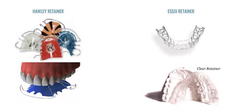 Do I Need A Replacement Retainer FULL BREAKDOWN