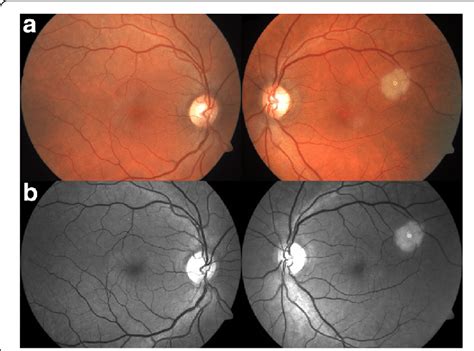 Colour Fundus Photography A Whitish Tumour With Calcification At The Download Scientific