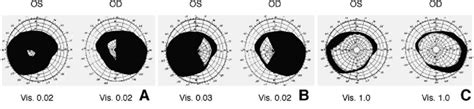 Diagrams Showing The Visual Fields And Acuity Before Surgery A One