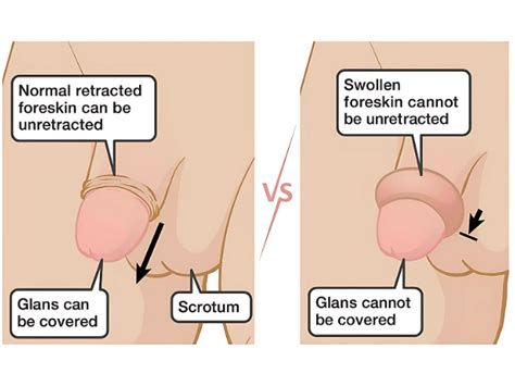 Best Swollen Penis Treatment In Karimnagar Expert Treatment At Kk Virat Hospital