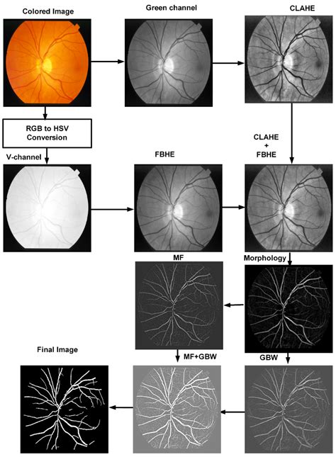 Retinal Angiography Image Segmentation Using Gabor Filters Diaf Top Sellers
