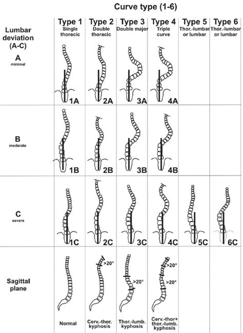 Spinal Deformities Classifications Used In Scoliosis Risser King And Lenke Source 1