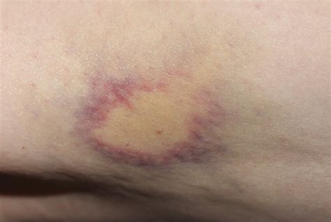 Circular Bug Bite Purple