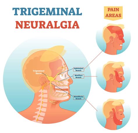 Trigeminal Neuralgia Causes Symptoms And Treatments