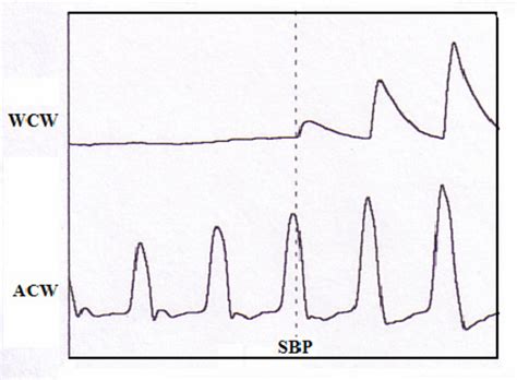 Wrist Cuff Waveforms Wcw And Arm Cuff Waveforms Acw Obtained