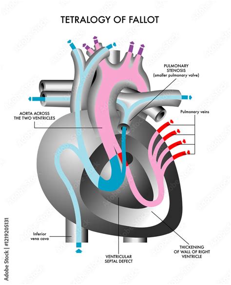 Schematic Illustration Of The Symptoms Of Tetralogy Of Fallot A