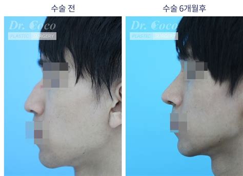 매부리코 닥터코코