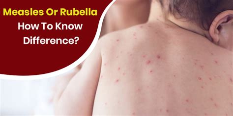 Measles Rubella Know The Difference Onlymyhealth