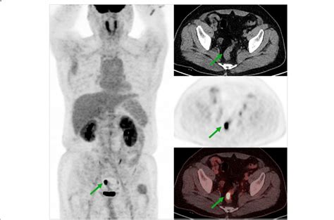 A 52 Year Old Man Had Right Partial Nephrectomy For Papillary Renal