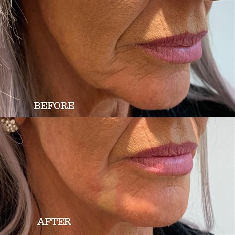 Check Out This Amazing Before After Photos Using W Type Pdo Threads 3 Threads On Each Side To