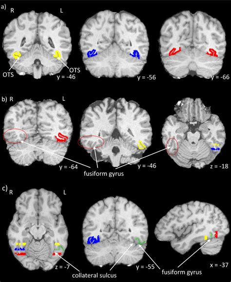 Pdf Ventral Occipito Temporal Cortex Function And Anatomical