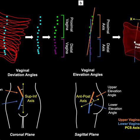 Calculation And Definition Of The Vaginal Angles A The Central Axis Download Scientific