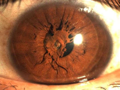 Iris Growing Over Pupil Rcringekeeper