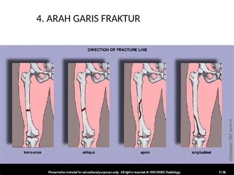 Fraktir Tulang Lokasi Anatomi Dan Perluasan Tipe Fraktur Alignment Dan