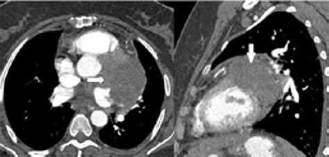 High Grade Pleomorphic Sarcoma In A 47 Year Old Female Patient 2 A B