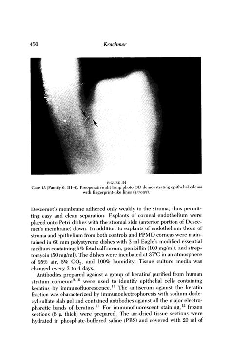 Posterior Polymorphous Corneal Dystrophy A Disease Characterized By