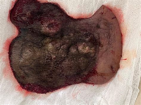 Scalp Angiosarcoma A Case Report Asian Journal Of Plastic And