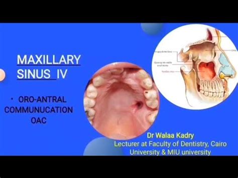 Maxillary Sinus Oro Antral Communication Youtube