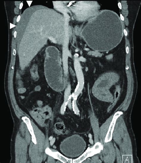 Coronal Ct Showing Haemoperitoneum Adjacent To The Liver Download