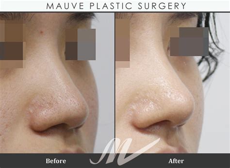 하이코시술 후 만족하지 못한 코라인 개선사례 코성형콧대코끝콧볼축소하이코제거 성형외과 전문의 칼럼 코성형 가슴성형 수술 사례 오똑한 콧날 낮은코 짧은 코끝