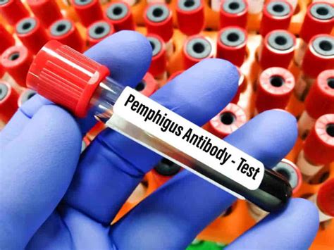 Pemphigus Types Symptoms Causes Diagnosis And Treatment