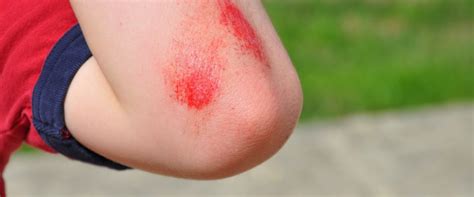Is Your Cut Infected What An Infected Cut Looks Like And How To Treat It
