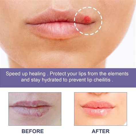 Lip Pimple Treatment