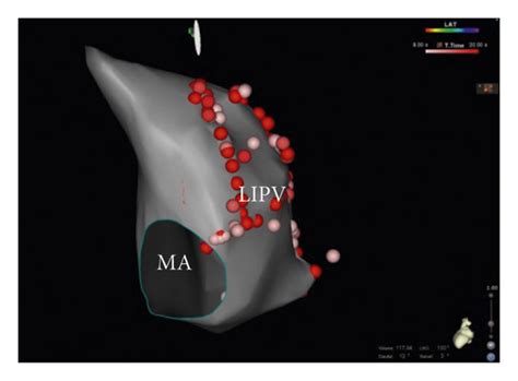 Representative Picture Of The Mi Line And Anterior Septal Line A Pvi