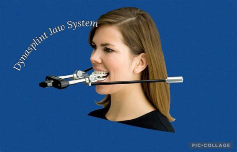 Adam Bordick Bsn Rn On Linkedin The Jaw Dynasplint® System Aids In Restoring Physical Function Adam Bordick Bsn Rn On Linkedin The Jaw Dynasplint® System Aids In Restoring Physical Function