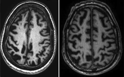 T1 Weighted Mri Axial Sections Showing Asymmetrical Frontoparietal Download Scientific Diagram