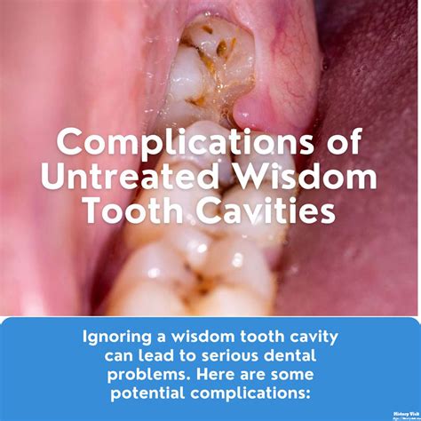 Wisdom Tooth Cavity Hidden Dangers And Solutions History Visit