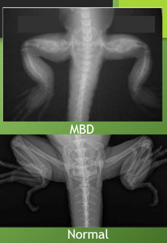 Nutritional Secondary Hyperparathyroidism Mbd Metabolic Bone Disease Flashcards Quizlet