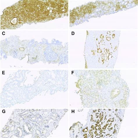 Staining Patterns Of Ihc Markers Scored As Continuous Variables